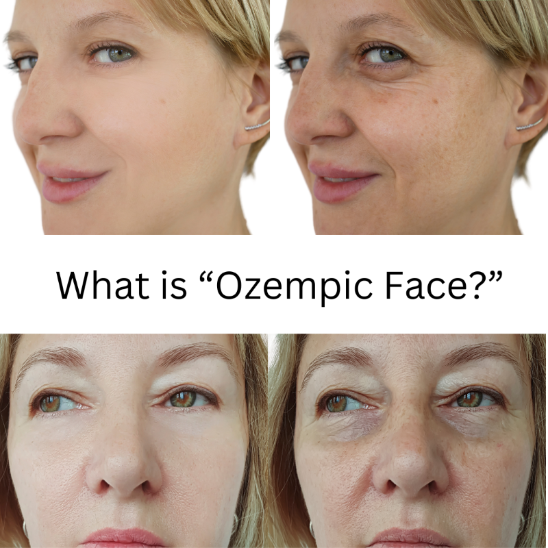 What Is Ozempic Face Change For Life Wellness Aesthetics